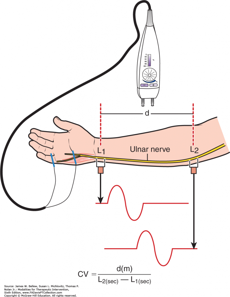 Eletroneuromiografia (ENMG) - Clínica Regenerati - Neurologia